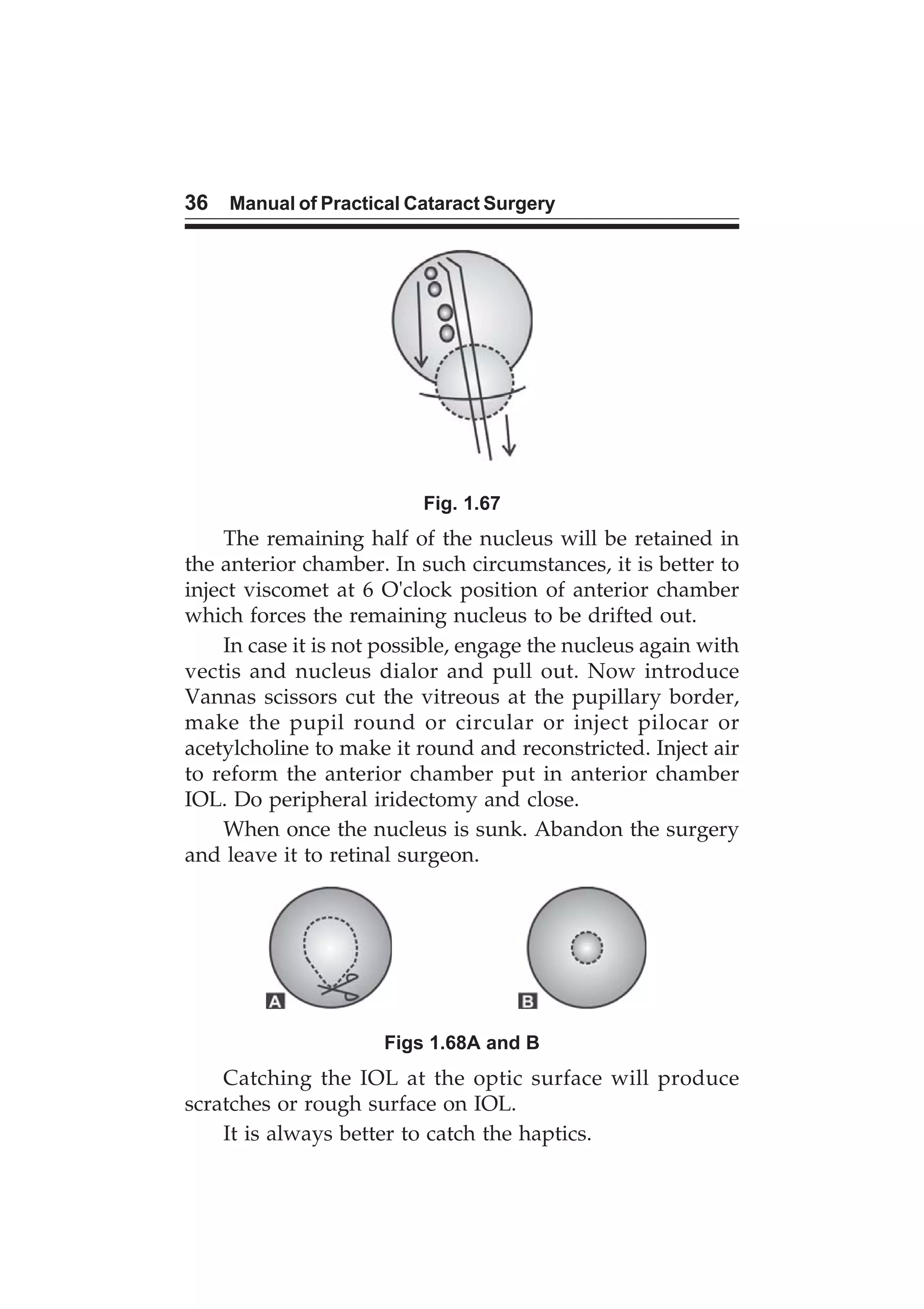 Manual of Practical Cataract Surgery.pdf | Eye and Vision Conditions ...