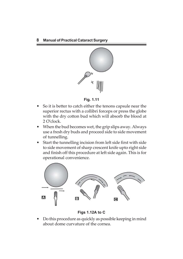 Manual of Practical Cataract Surgery.pdf | Eye and Vision Conditions ...