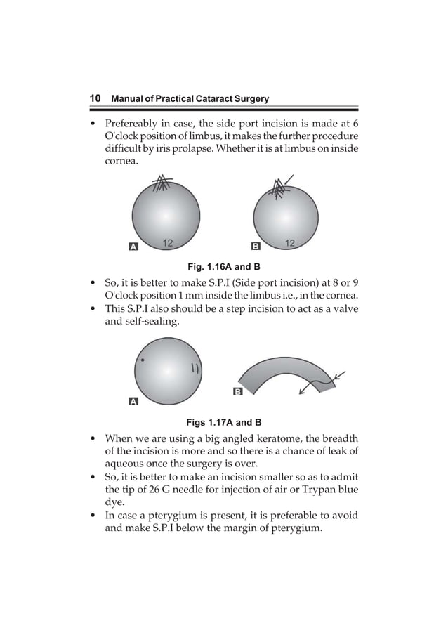 Manual of Practical Cataract Surgery.pdf | Eye and Vision Conditions ...