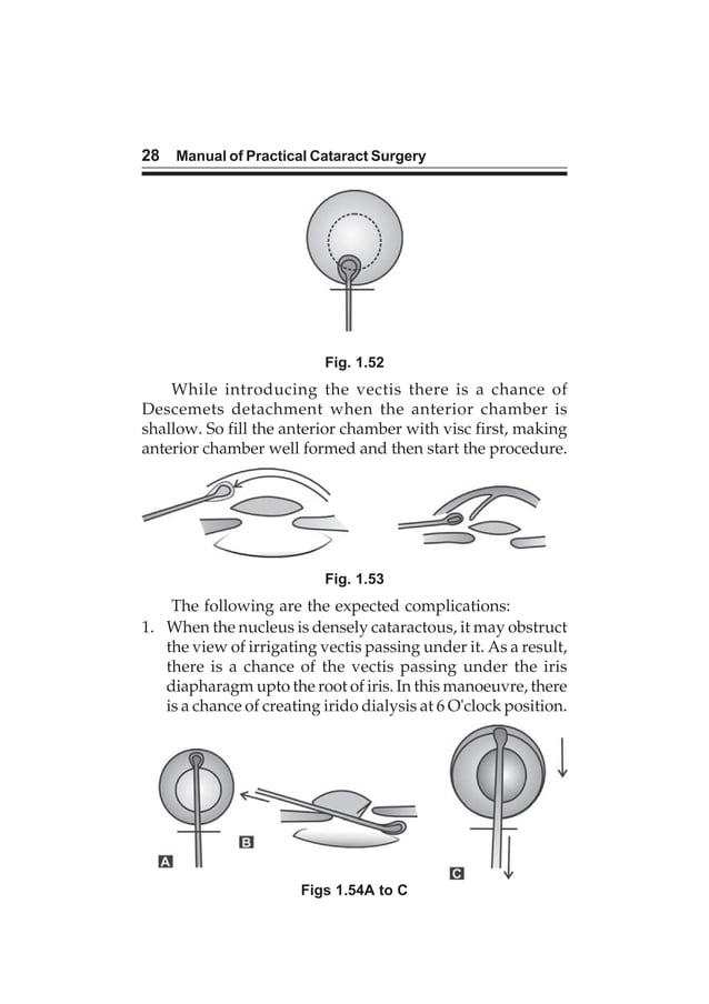 Manual of Practical Cataract Surgery.pdf | Eye and Vision Conditions ...