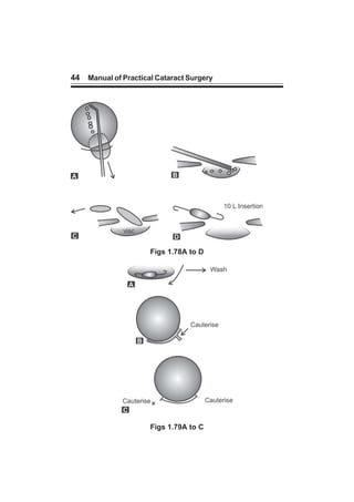 Manual of Practical Cataract Surgery.pdf
