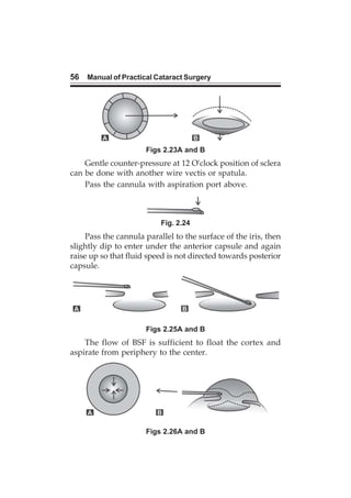 Manual of Practical Cataract Surgery.pdf