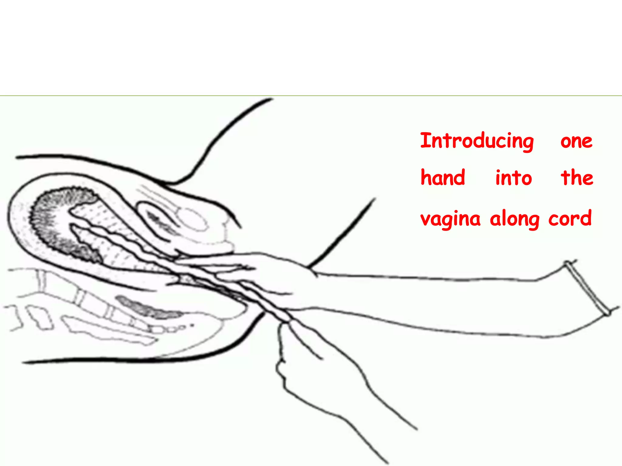 Manual Removal of Placenta | PPTX