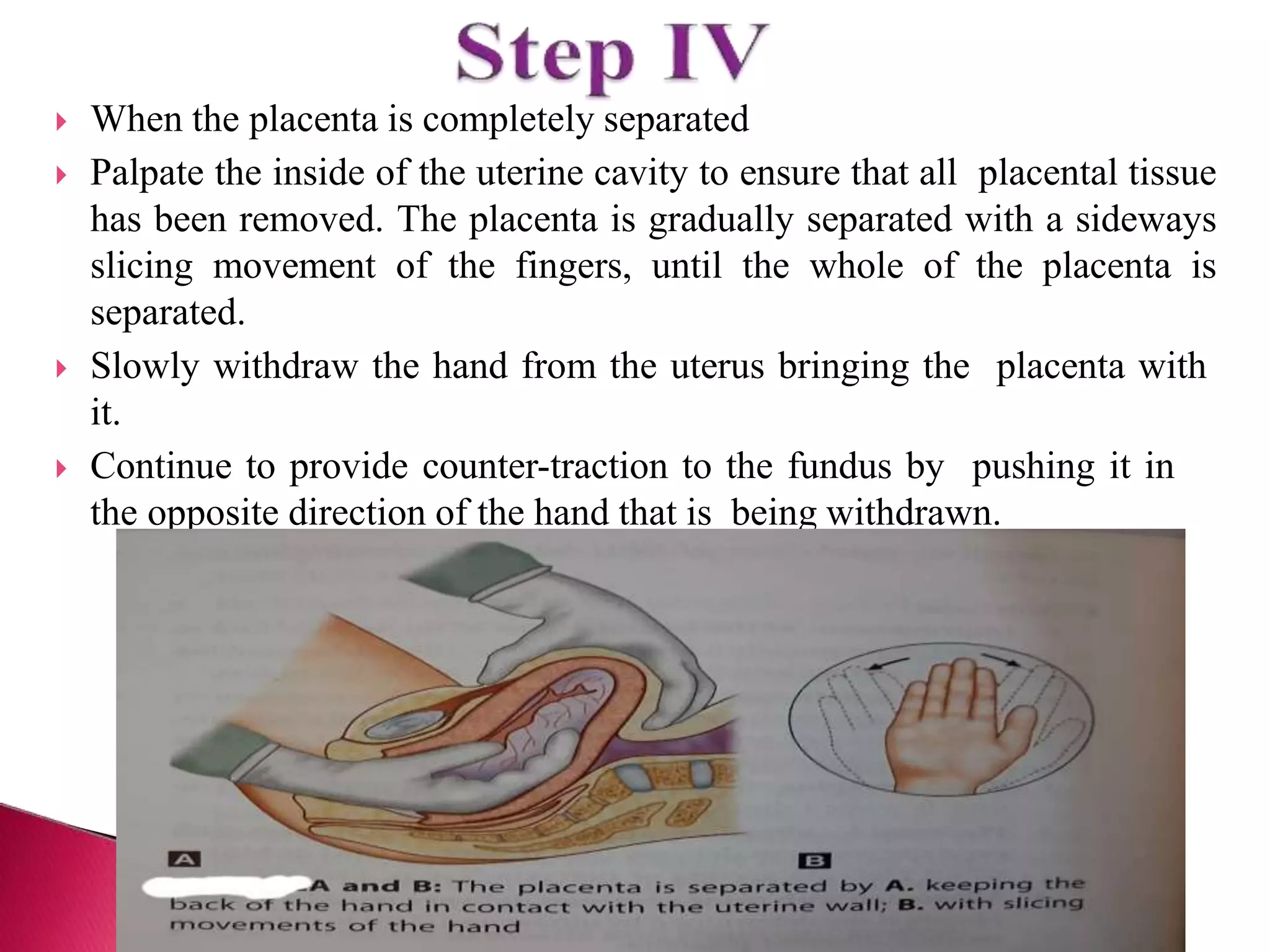 Manual removal of placenta.pptx