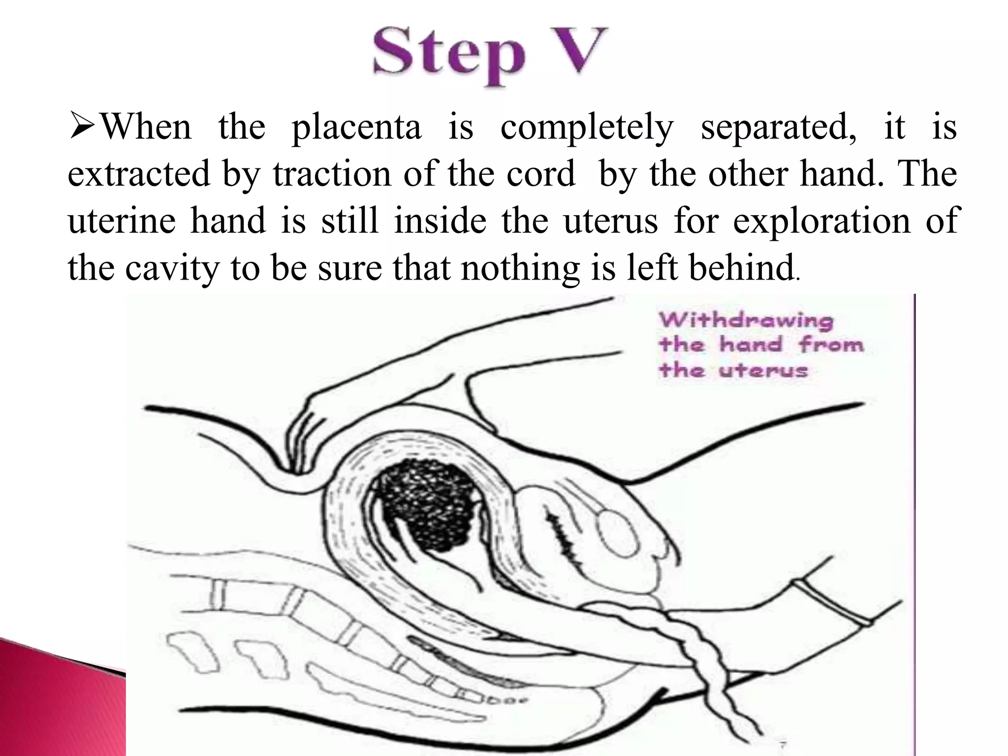 Manual removal of placenta.pptx