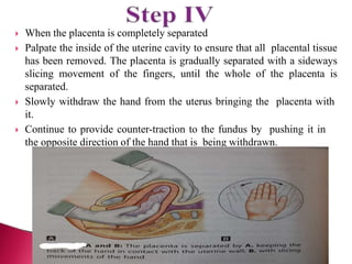 Manual removal of placenta.pptx