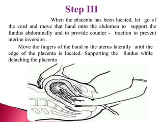 Manual removal of placenta.pptx