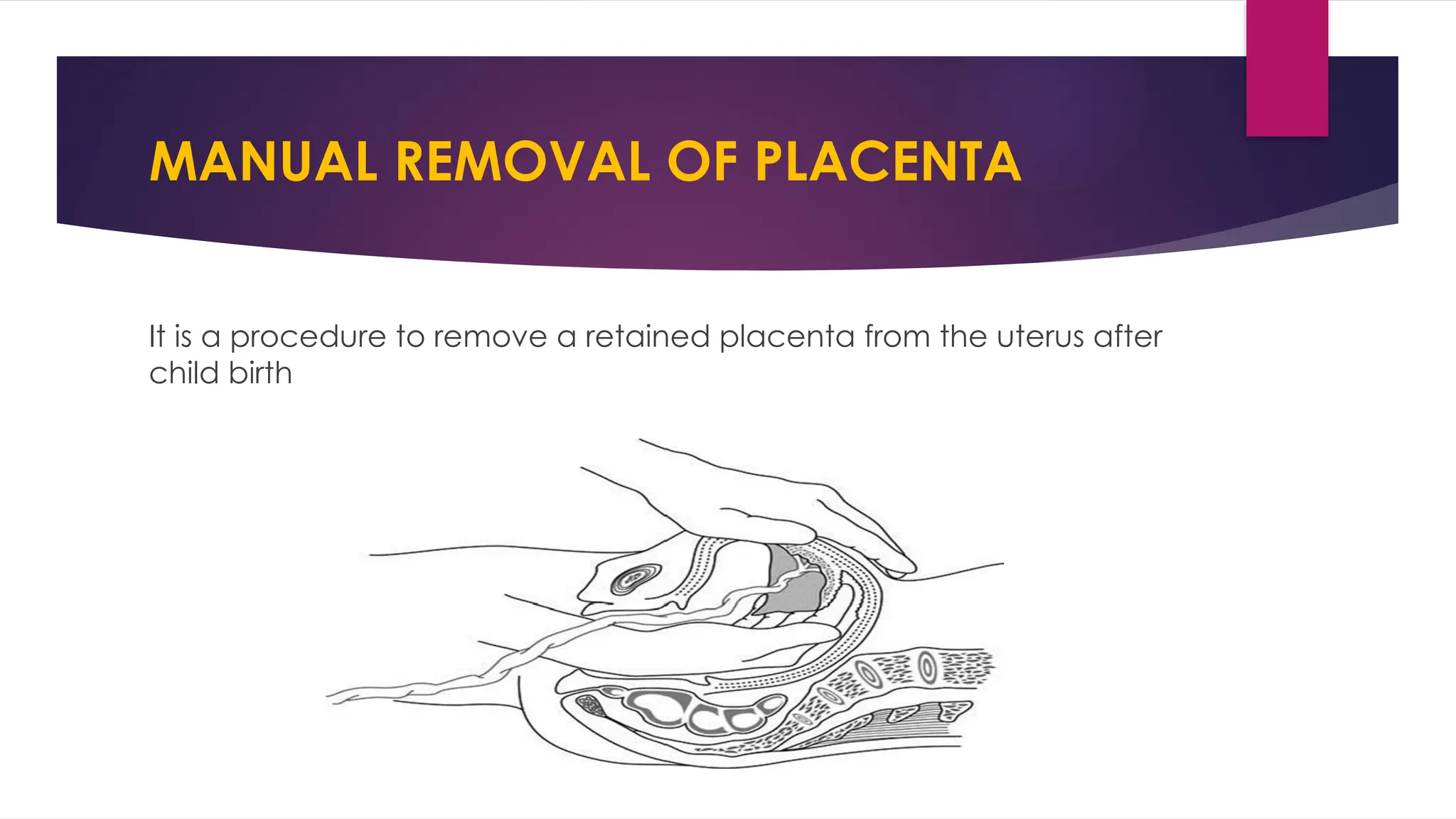 RETAINED PLACENTA AND MANUAL REMOVAL OF PLACENTA.pptx