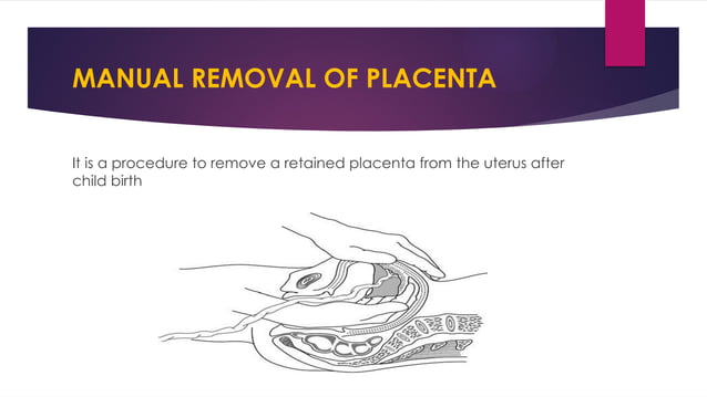 RETAINED PLACENTA AND MANUAL REMOVAL OF PLACENTA.pptx