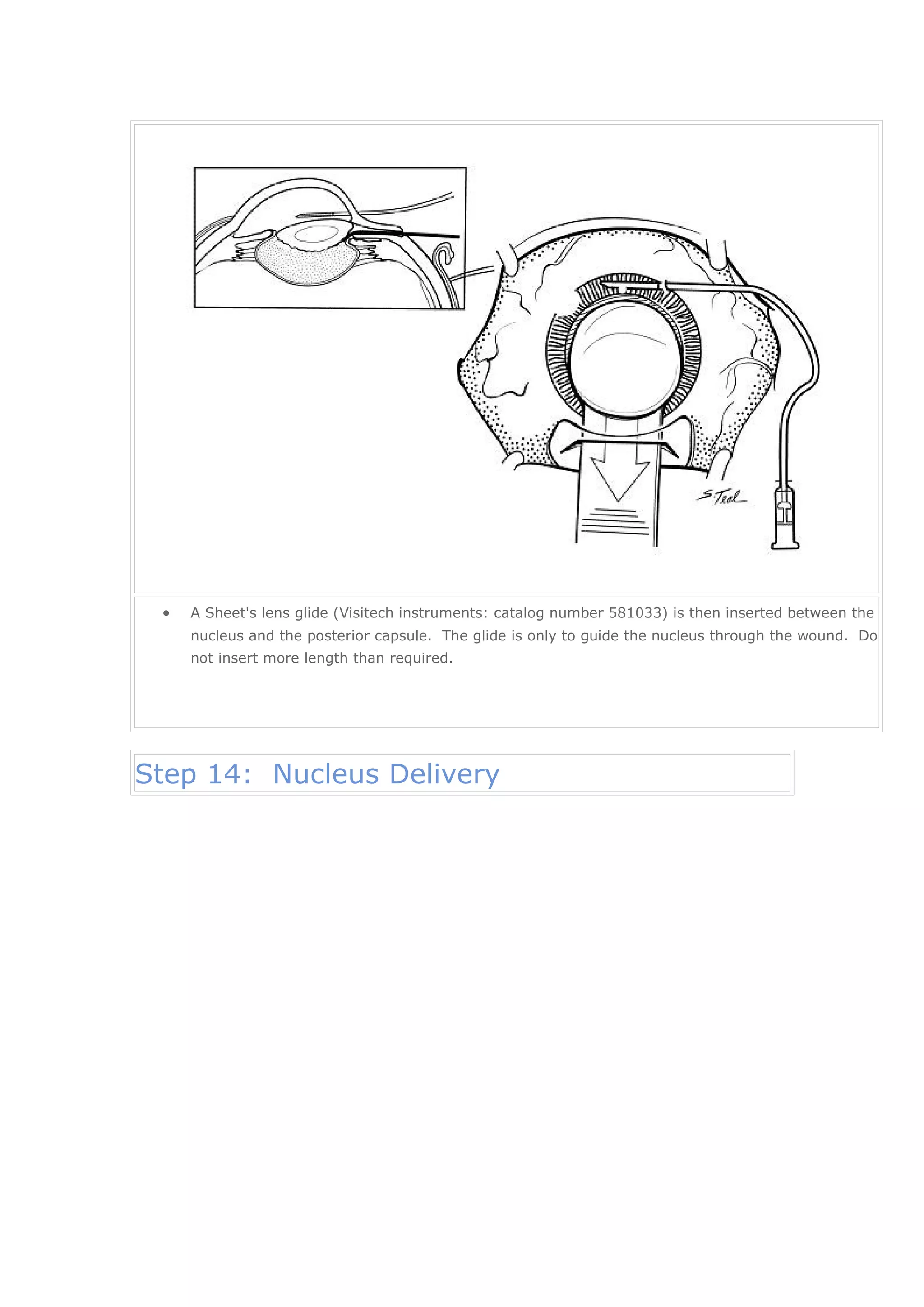 Manual small incision cataract surgery | DOC