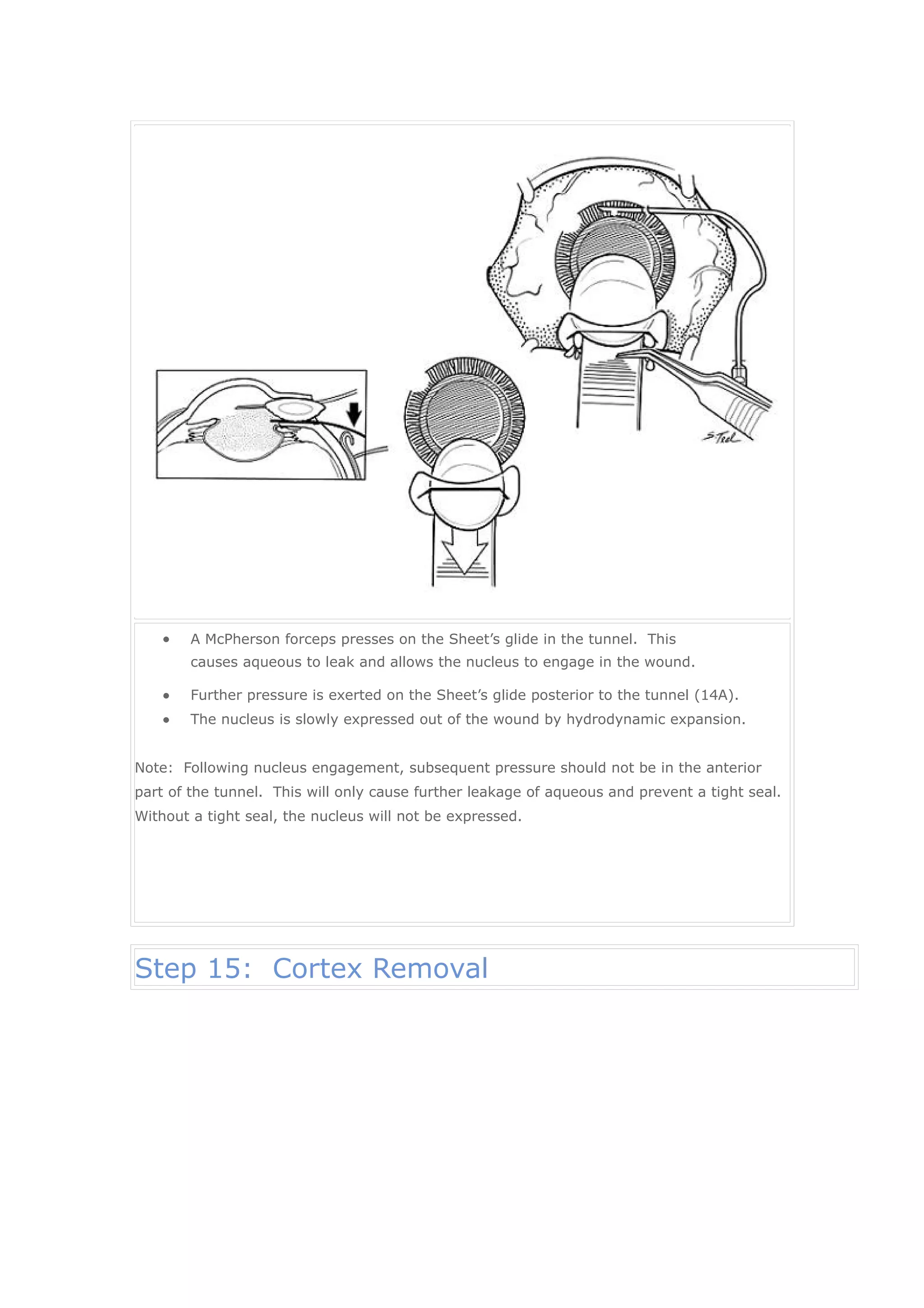 Manual small incision cataract surgery | DOC