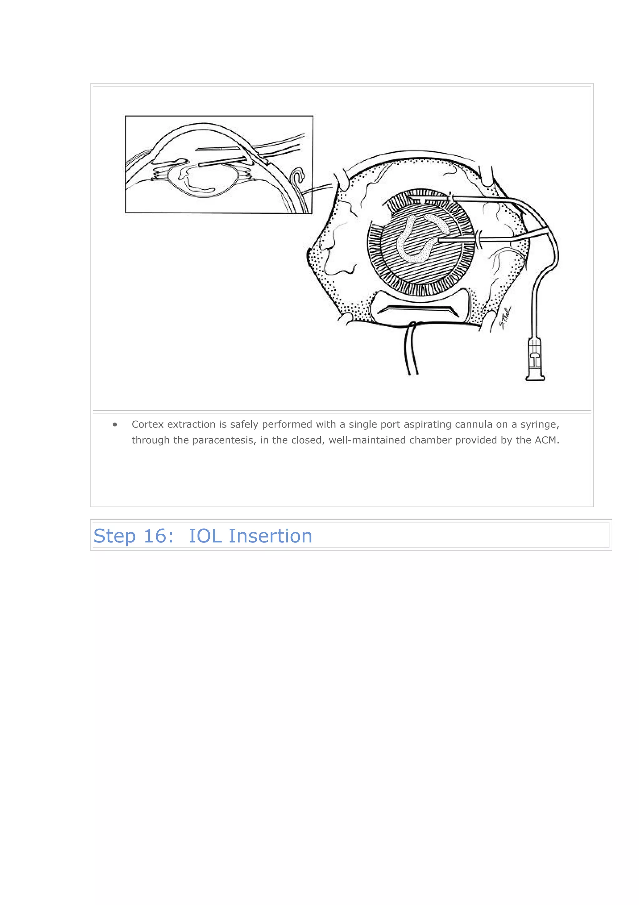 Manual small incision cataract surgery | DOC