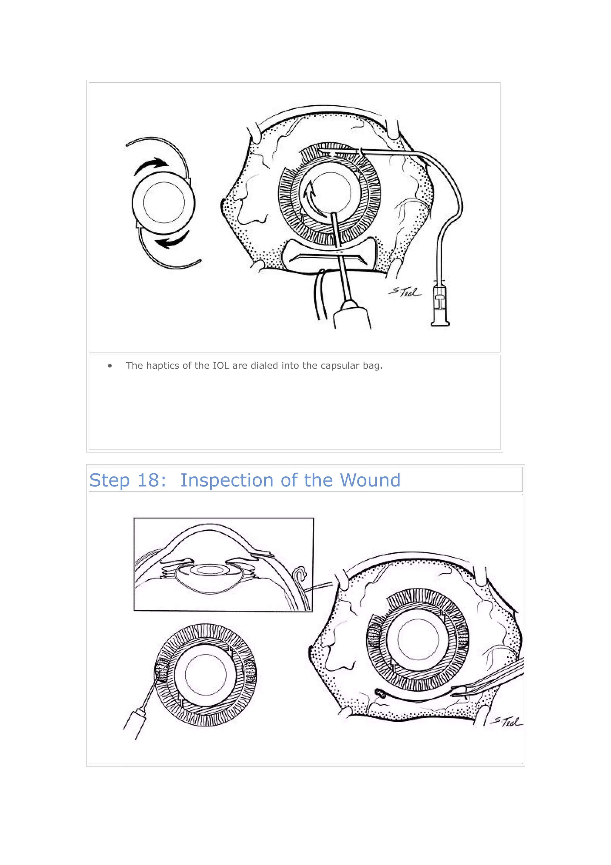 Manual small incision cataract surgery | DOC