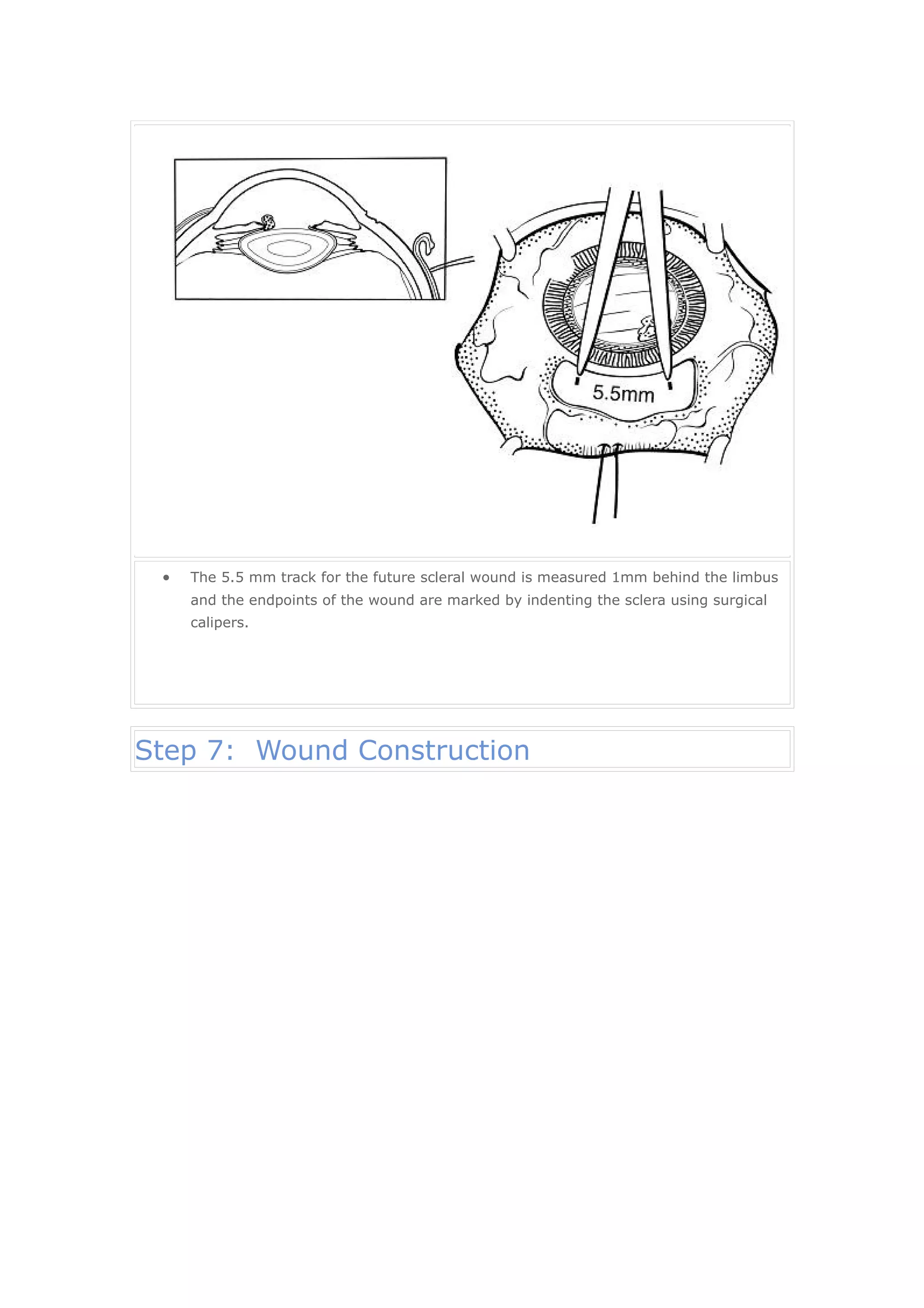 Manual small incision cataract surgery | DOC