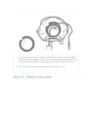 Manual small incision cataract surgery | DOC