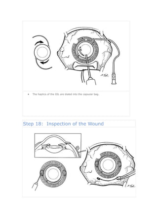 Manual small incision cataract surgery | DOC