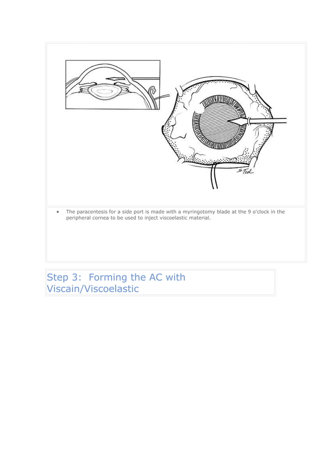 Manual small incision cataract surgery | DOC
