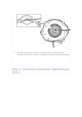 Manual small incision cataract surgery | DOC