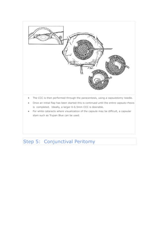 Manual small incision cataract surgery | DOC
