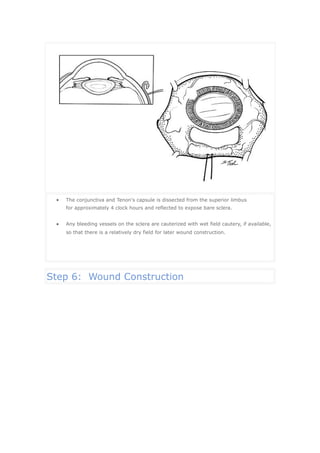 Manual small incision cataract surgery | DOC