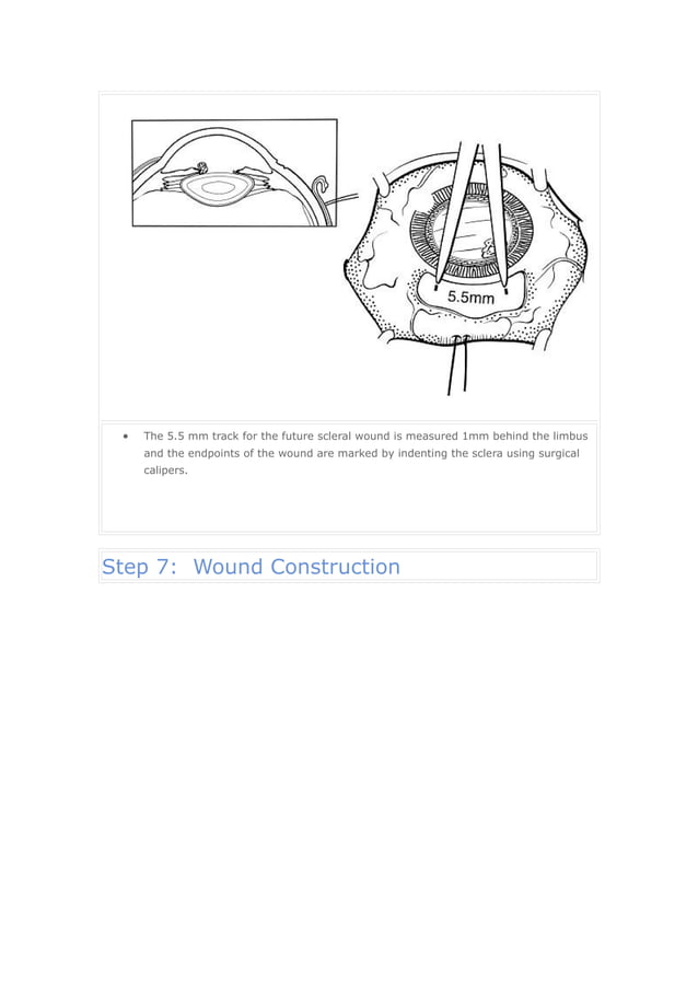 Manual small incision cataract surgery | DOC