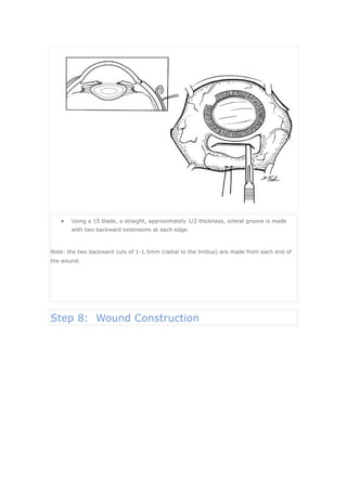 Manual small incision cataract surgery | DOC