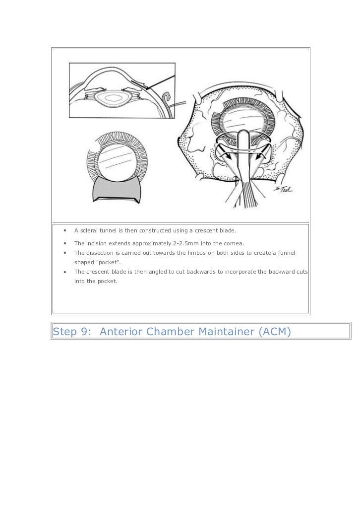 Manual Small Incision Cataract Surgery