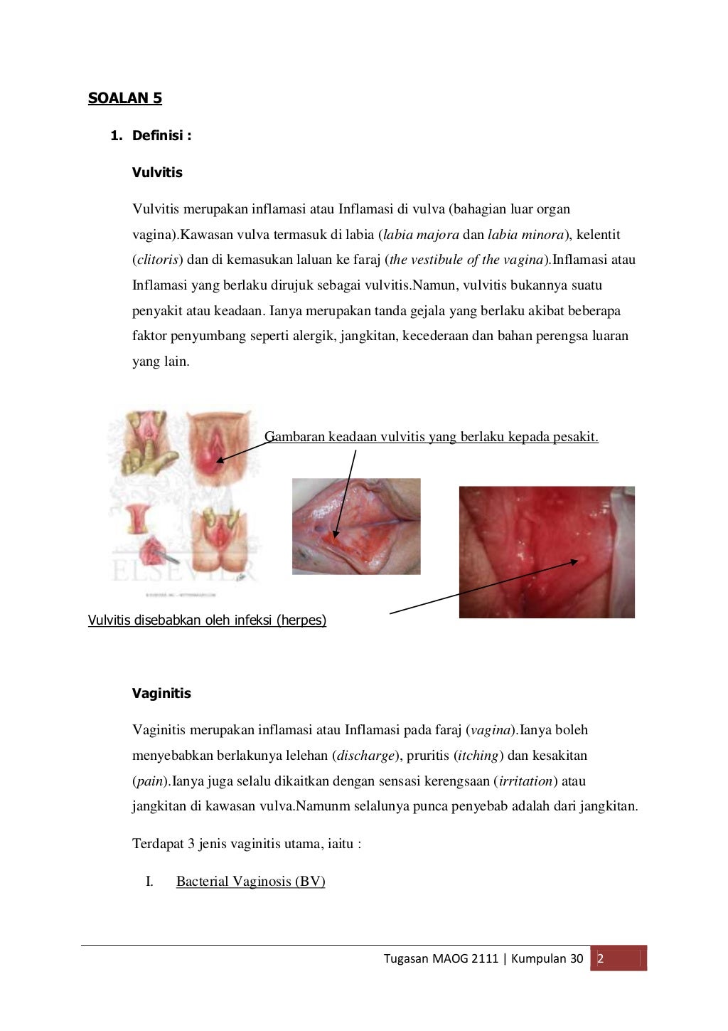 Vaginitis, Vulvitis dan Vulvovaginitis
