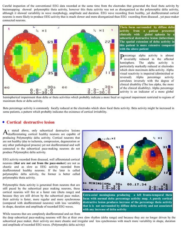 Issues in brain mapping...Polymorphic delta activity and its brainmap ...