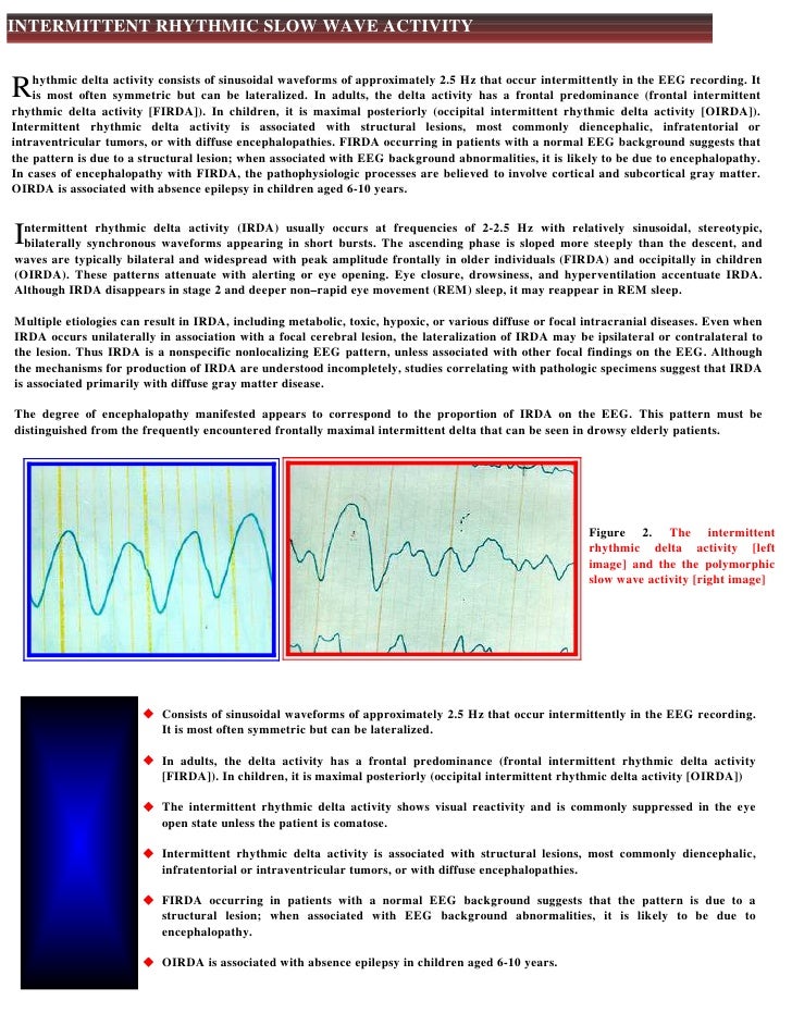 Issues In Brainmappingintermittent Rhythmic Delta Activity And Its
