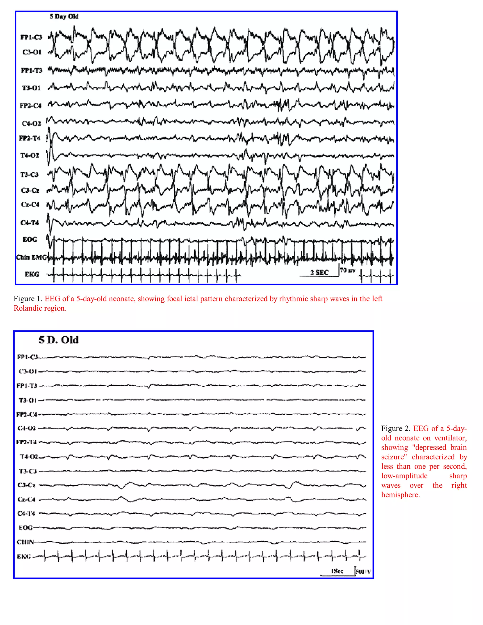 Issues in brainmapping...Neonatal EEG | PDF