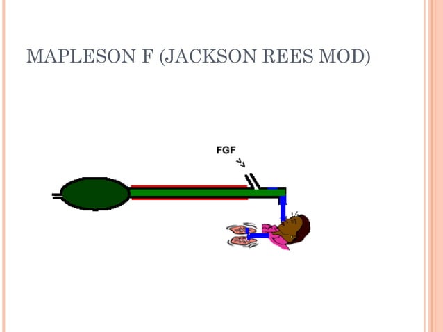 Mapleson circuits | PPT | Lung and Respiratory Health | Diseases and ...
