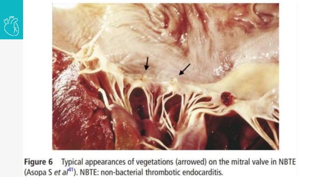 Marantic Endocarditis.pptx