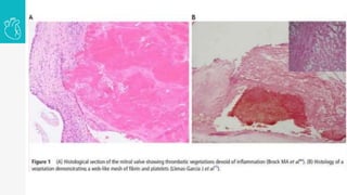 Marantic Endocarditis.pptx