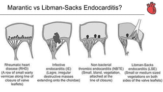 Marantic Endocarditis.pptx