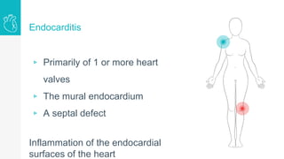 Marantic Endocarditis.pptx