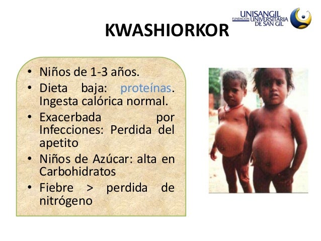 Marasmo kwashiorkor