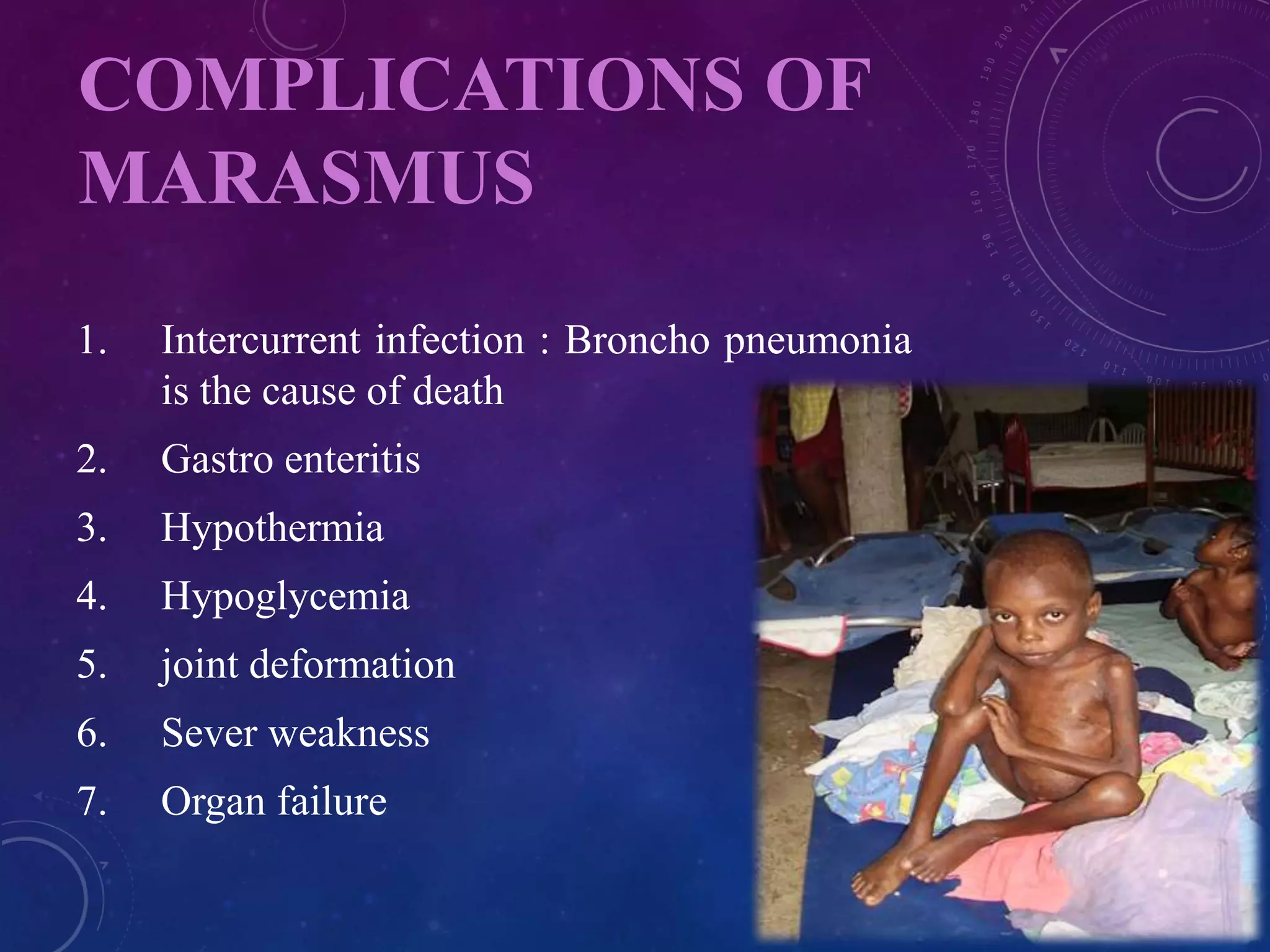 Marasmus a short description | PPT