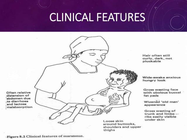 Marasmus a short description | PPT | Nutrition | Healthy Living