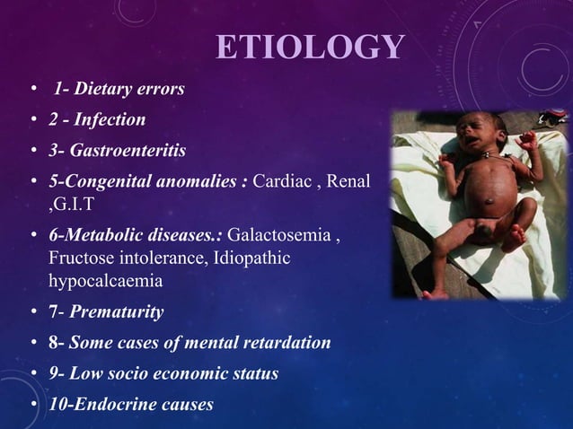 Marasmus a short description | PPT | Nutrition | Healthy Living