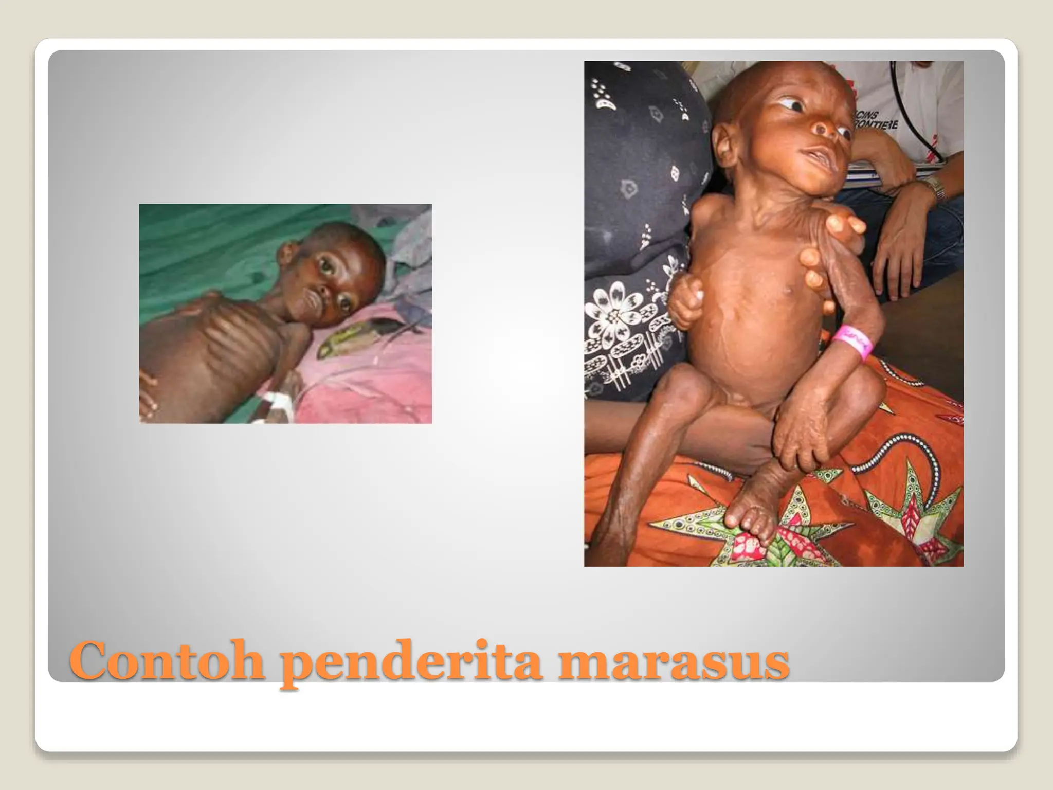 MARASMUS_Marasmus_marasmus_marasmus_marasmuspptx | PPTX