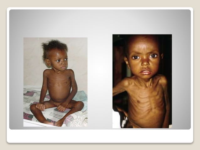 MARASMUS_Marasmus_marasmus_marasmus_marasmuspptx | PPTX