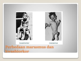 MARASMUS_Marasmus_marasmus_marasmus_marasmuspptx | PPTX