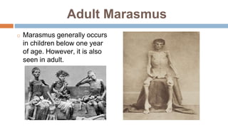 Marasmus mbbs nutritional biochemstry.pptx