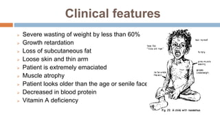 Marasmus mbbs nutritional biochemistry.pptx