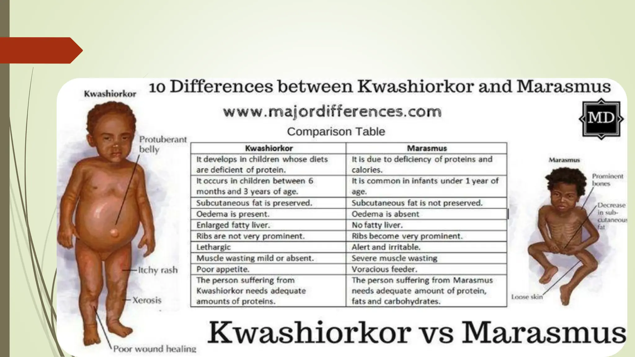 MARASMUS.pdf marsmus pptx difference between marsmus and kwashiorkor presentation about marsmus ...