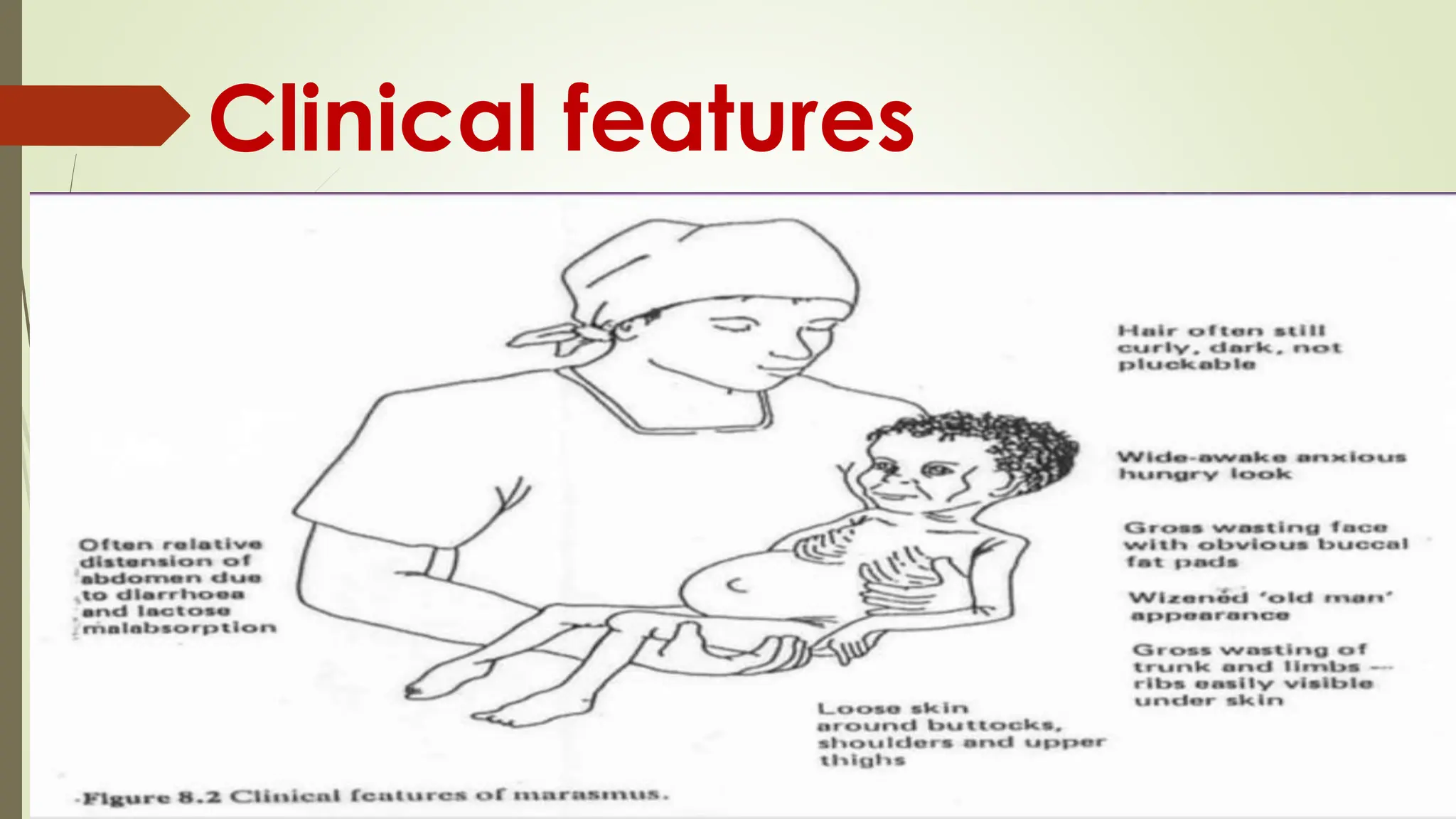 MARASMUS.pdf marsmus pptx difference between marsmus and kwashiorkor presentation about marsmus ...