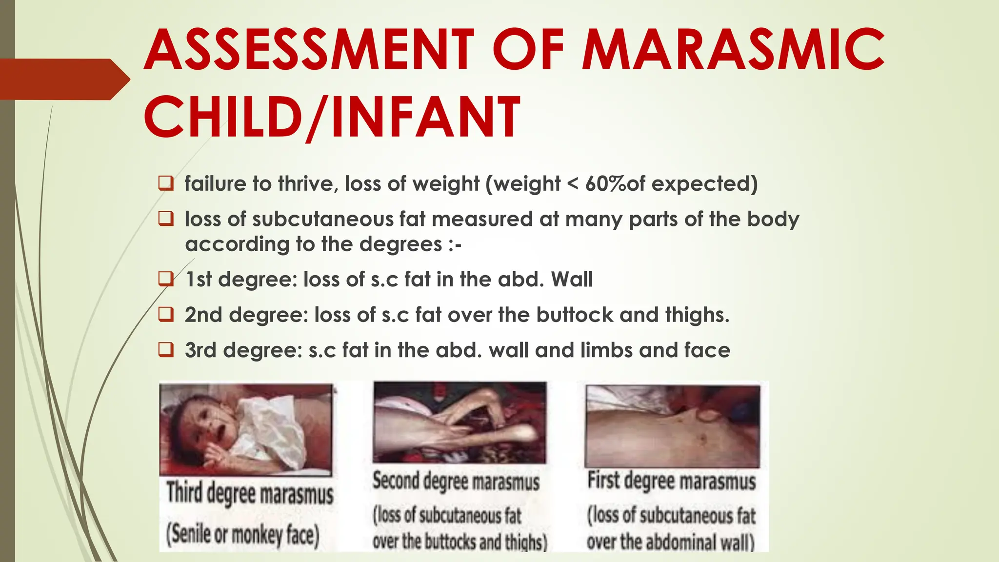 MARASMUS.pdf marsmus pptx difference between marsmus and kwashiorkor presentation about marsmus ...