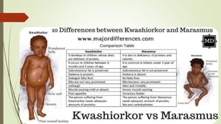 MARASMUS.pdf marsmus pptx difference between marsmus and kwashiorkor presentation about marsmus ...