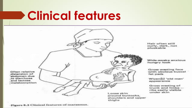 MARASMUS.pdf marsmus pptx difference between marsmus and kwashiorkor ...